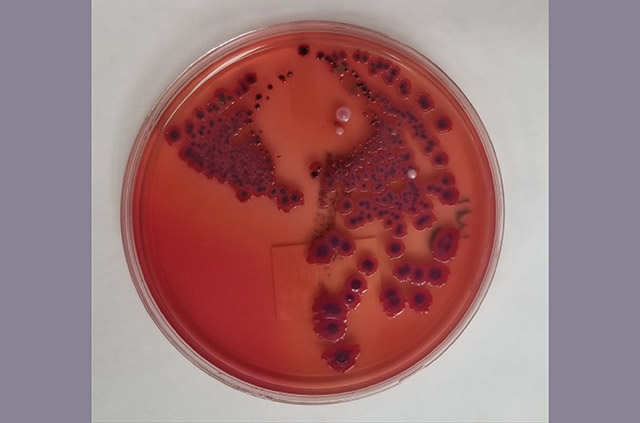 Rising Cases of Antibiotic-Resistant Shigella Among Philadelphia's ...