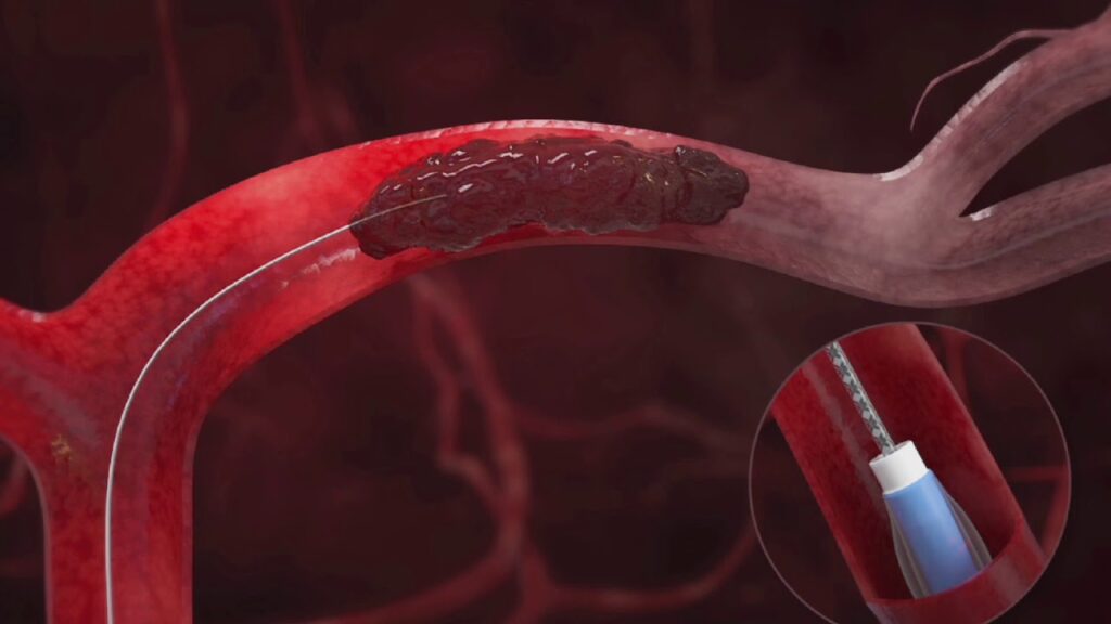 Growing Adoption of Minimally Invasive Surgical Procedures